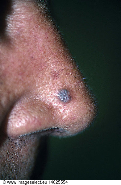 Basal Cell Carcinoma On Nose Basal Cell Carcinoma On Nosebasal Cell Carcinomabcc