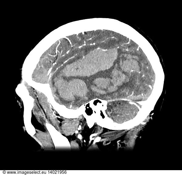 CT of Massive Intracranial Hemorrhage CT of Massive Intracranial ... CT of Massive Intracranial Hemorrhage CT of Massive Intracranial ...