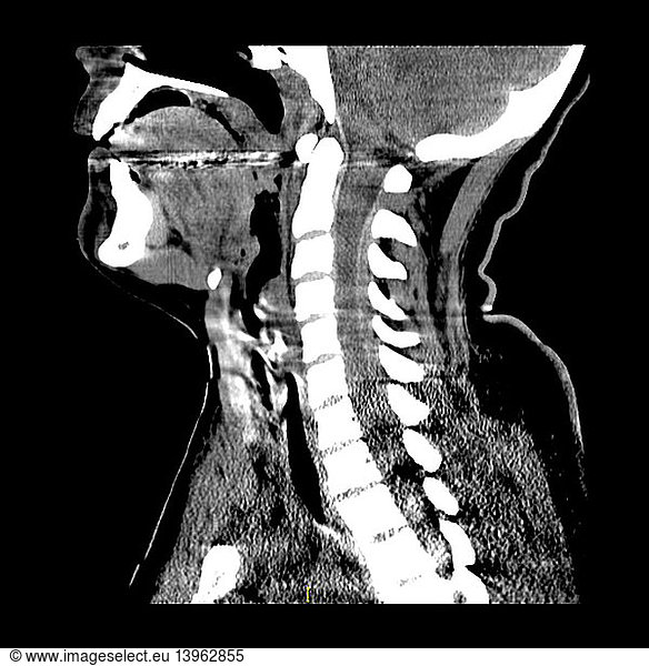 Epidural Hematoma Epidural Hematoma, CT Scan,abnormal ct cervical spine ... Epidural Hematoma Epidural Hematoma, CT Scan,abnormal ct cervical spine ...