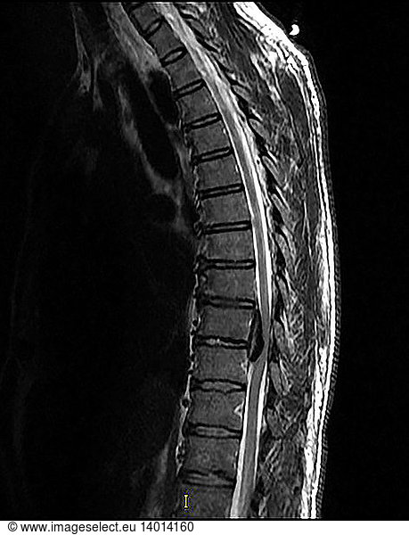 Huge Calcified Thoracic Disc Herniation Huge Calcified Thoracic Disc Herniation Mriabnormal