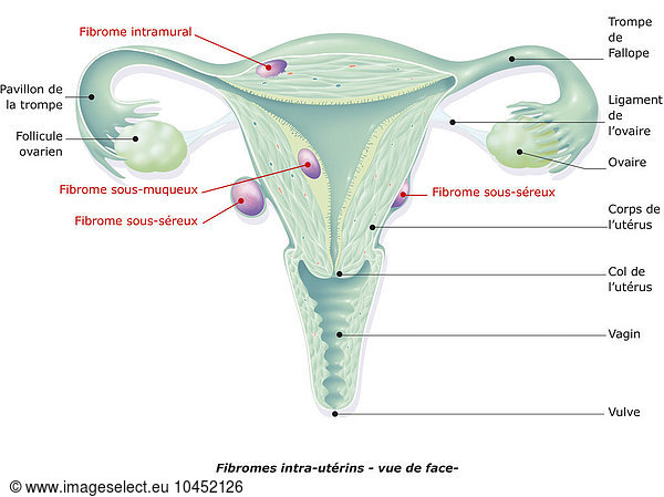 Illustration Of 3 Types Of Uterine Fibroids At The Top Illustration Of 3 Types Of Uterine