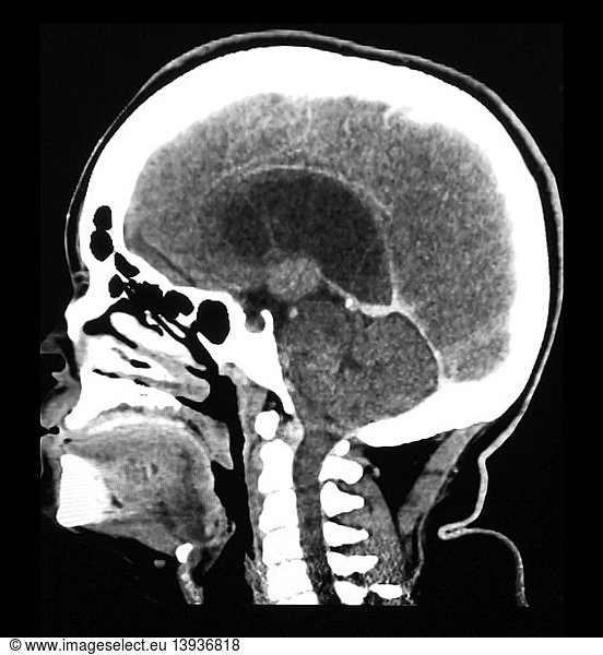 Imaging Of Colloid Cyst Imaging Of Colloid Cyst Ctabnormal Ct Headabnormalabnormality