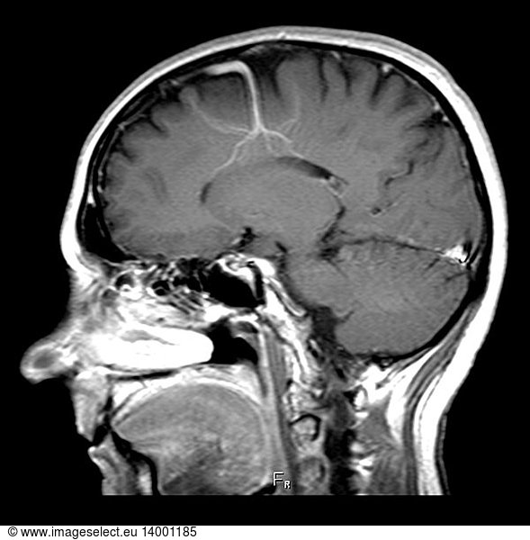 Large Developmental Venous Anomaly Large Developmental Venous Anomaly ... Large Developmental Venous Anomaly Large Developmental Venous Anomaly ...