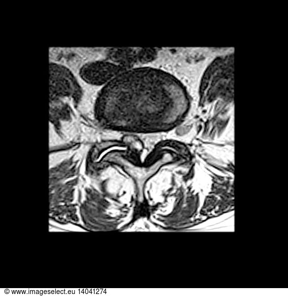 Large Synovial Cyst With Spinal Steno Large Synovial Cyst With Spinal Stenodegenerative Disease