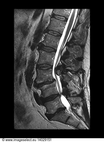 Mri Lumbar Degenerative Spinal Stenosis Mri Lumbar Degenerative Spinal Stenosisabnormal Lumbar