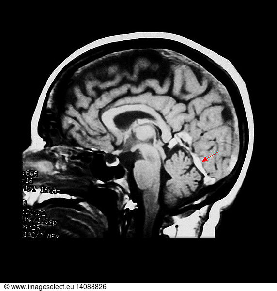 Mri Of Dural Sinus Thrombosis Mri Of Dural Sinus Thrombosisabnormal Cerebral Veinsabnormal