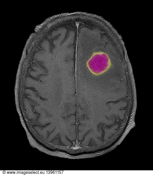 Mri Of Encapsulated Abscess In Frontal Lobe Mri Of Encapsulated Abscess In Frontal Lobeabnormal
