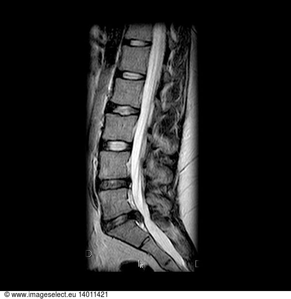 Mri Of Lumbar Disc Herniation Mri Of Lumbar Disc Herniation Arthritis