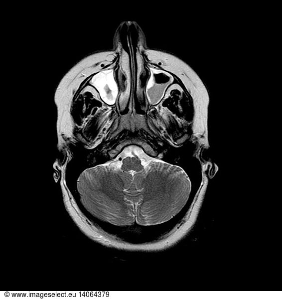 Mri Of Maxillary Sinusitis Mri Of Maxillary Sinusitis Abnormal Mri
