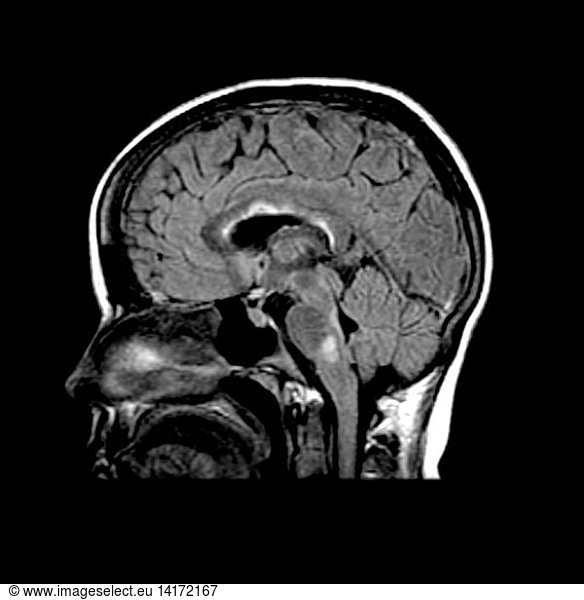 Mri Of Multiple Sclerosis Mri Of Multiple Sclerosisabnormal Cerebral White Matterabnormal