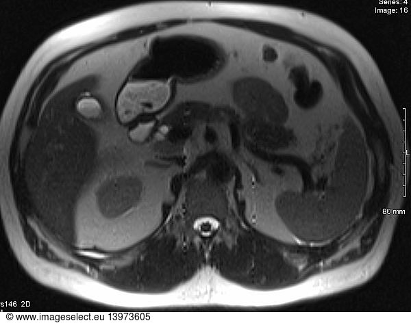 Normal Spleen Normal Spleen Mriabdomenaxialimaging Rights Managed Imageselect 13973605