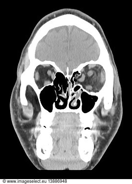 Orbital Wall Fracture Orbital Wall Fracture Ct Scanabnormal Ctabnormalmovement Rights