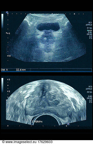 Prostate Ultrasound To Visualize The Volume And Structure Of The