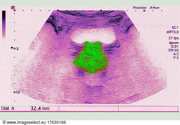 Prostate Ultrasound To Visualize The Volume And Structure Of The