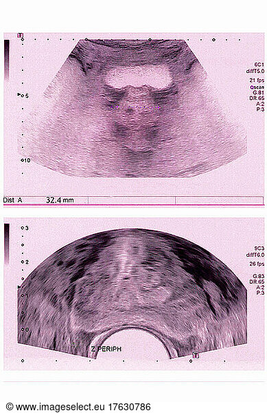 Prostate Ultrasound To Visualize The Volume And Structure Of The