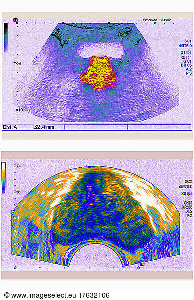 Prostate Ultrasound To Visualize The Volume And Structure Of The