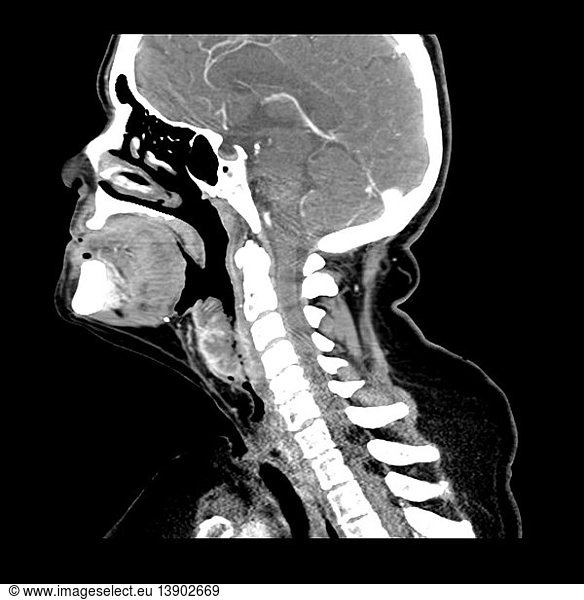 Recurrent Squamous Cell Cancer Larynx Recurrent Squamous Cell Cancer Larynx Ct Scanabnormal