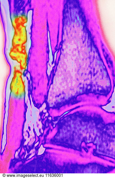 Ruptured Achilles Tendon Ruptured Achilles Tendon Seen On A Sagittal Section Mri Scan Of The