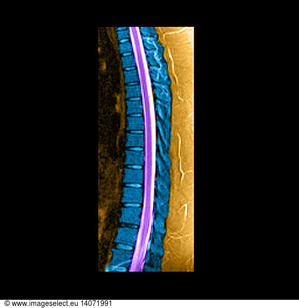 Sagittal MRI of Normal Thoracic Spine Sagittal MRI of Normal Thoracic ... Sagittal MRI of Normal Thoracic Spine Sagittal MRI of Normal Thoracic ...